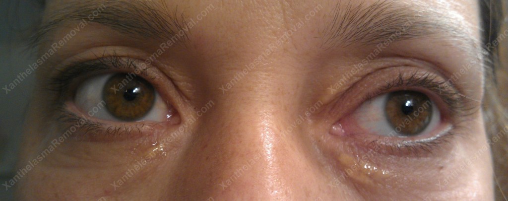 How to apply the XanthRemover : Xanthelasma Removal
