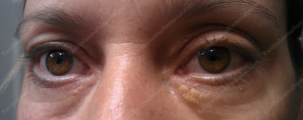 How to apply the XanthRemover : Xanthelasma Removal