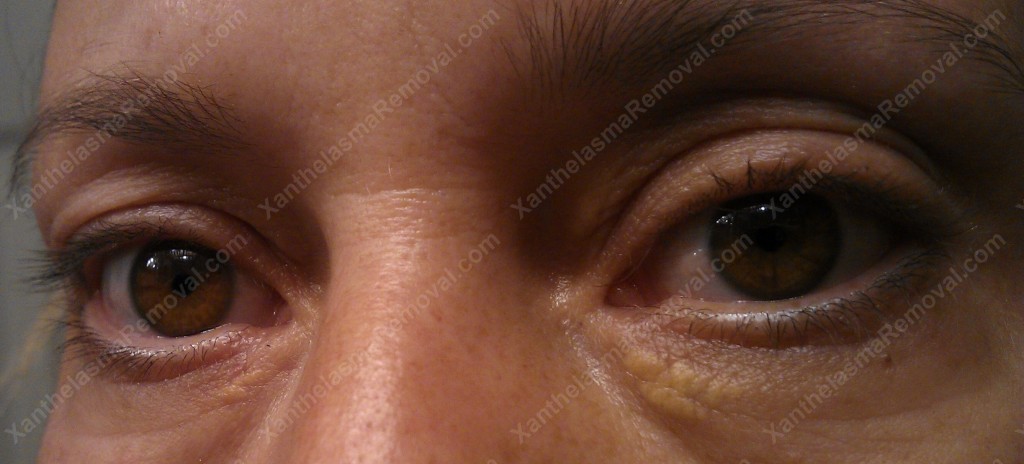How to apply the XanthRemover : Xanthelasma Removal