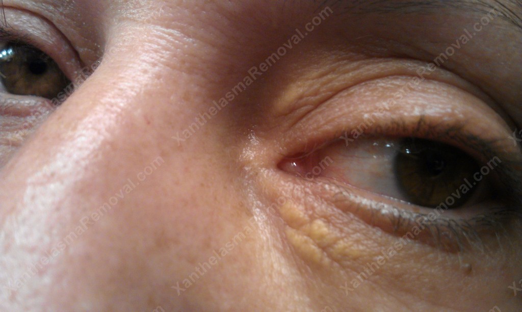 How to apply the XanthRemover : Xanthelasma Removal