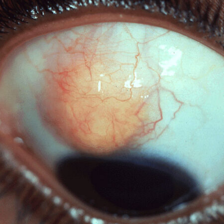 What is Xanthelasma? Xanthelasmas And Xanthomas - Xanthelasma Removal