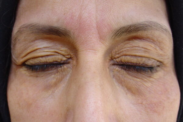 What is Xanthelasma? - Xanthelasma Removal