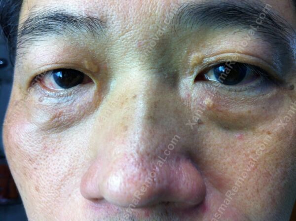 Xanthelasma Removed in Singapore - Xanthelasma Removal
