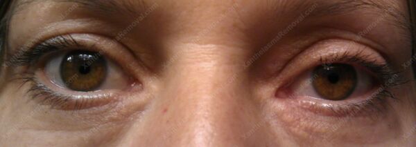 How to apply the XanthRemover - Xanthelasma Removal