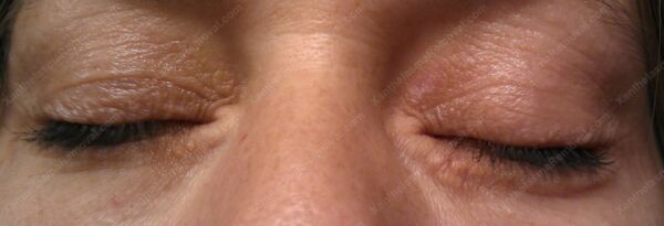 How to apply the XanthRemover - Xanthelasma Removal