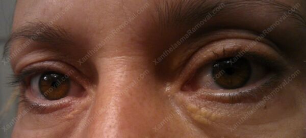 How to apply the XanthRemover - Xanthelasma Removal